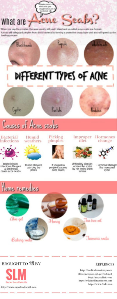 40 Best Ways to Get Rid of Acne Scabs Overnight | DIY | Home Remedies