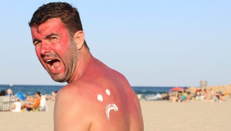 How To Get Rid Of Sunburns Fast With Home Remedies And Treatments