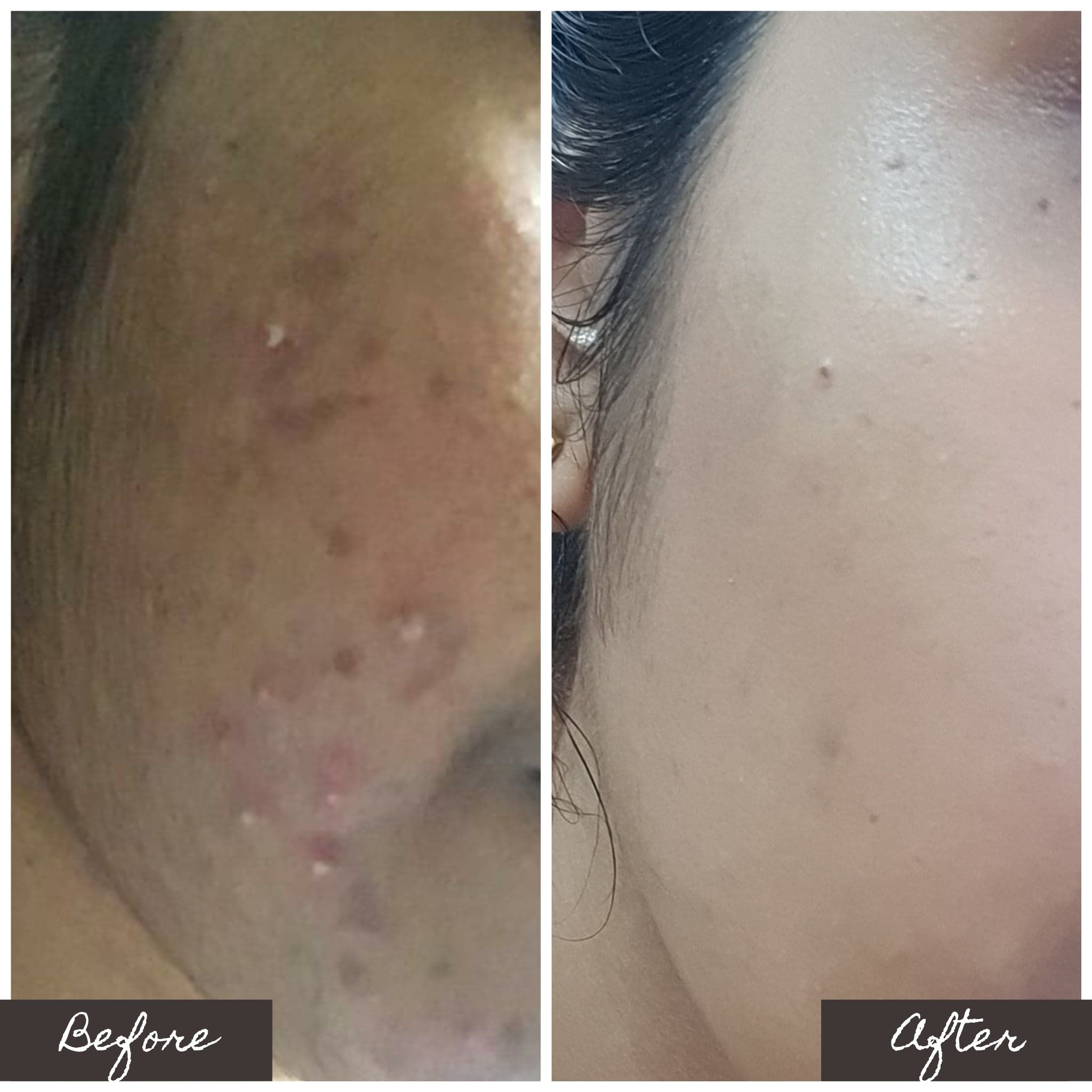 Transformation to spotless glowing skin - Superloudmouth