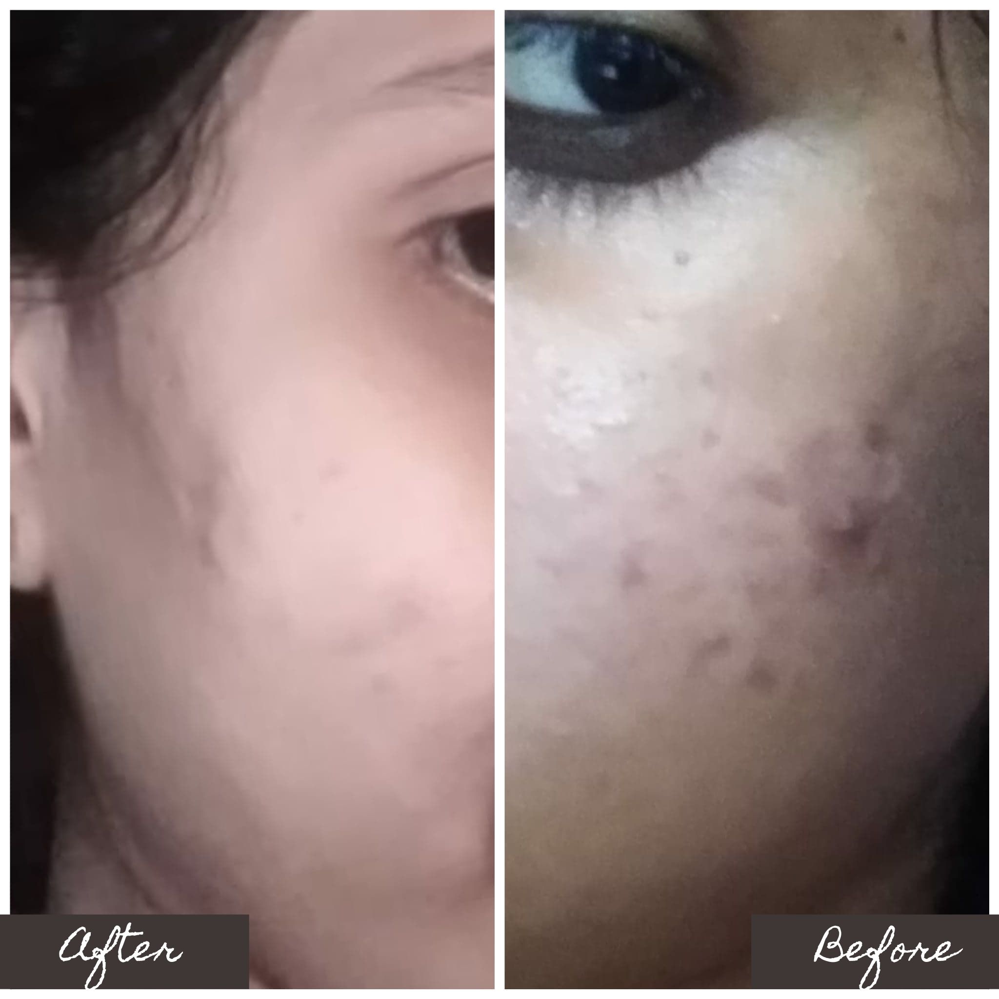 Transformation to spotless glowing skin - Superloudmouth